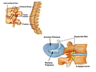 intervertebral disc prolapse | PPSX
