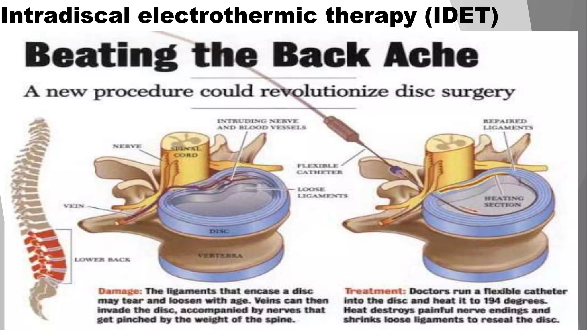 Intervertebral disk prolapse | PPTX