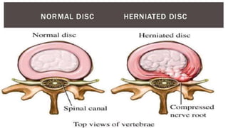 IVDP Musculo Skeletal Disorders For Nursing Student Under Medical ...