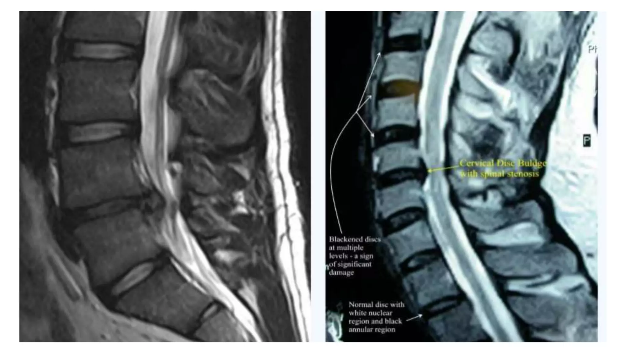 Inter vertebral disc prolapse | PPTX