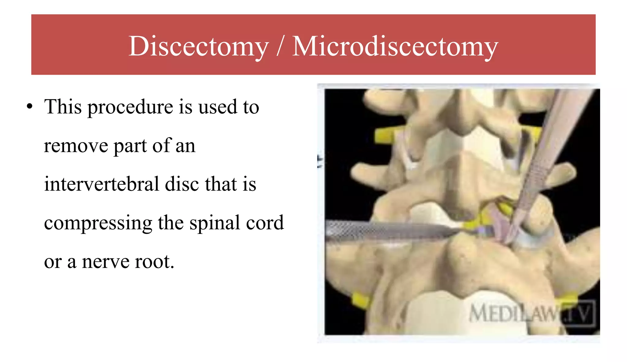 Inter vertebral disc prolapse | PPTX
