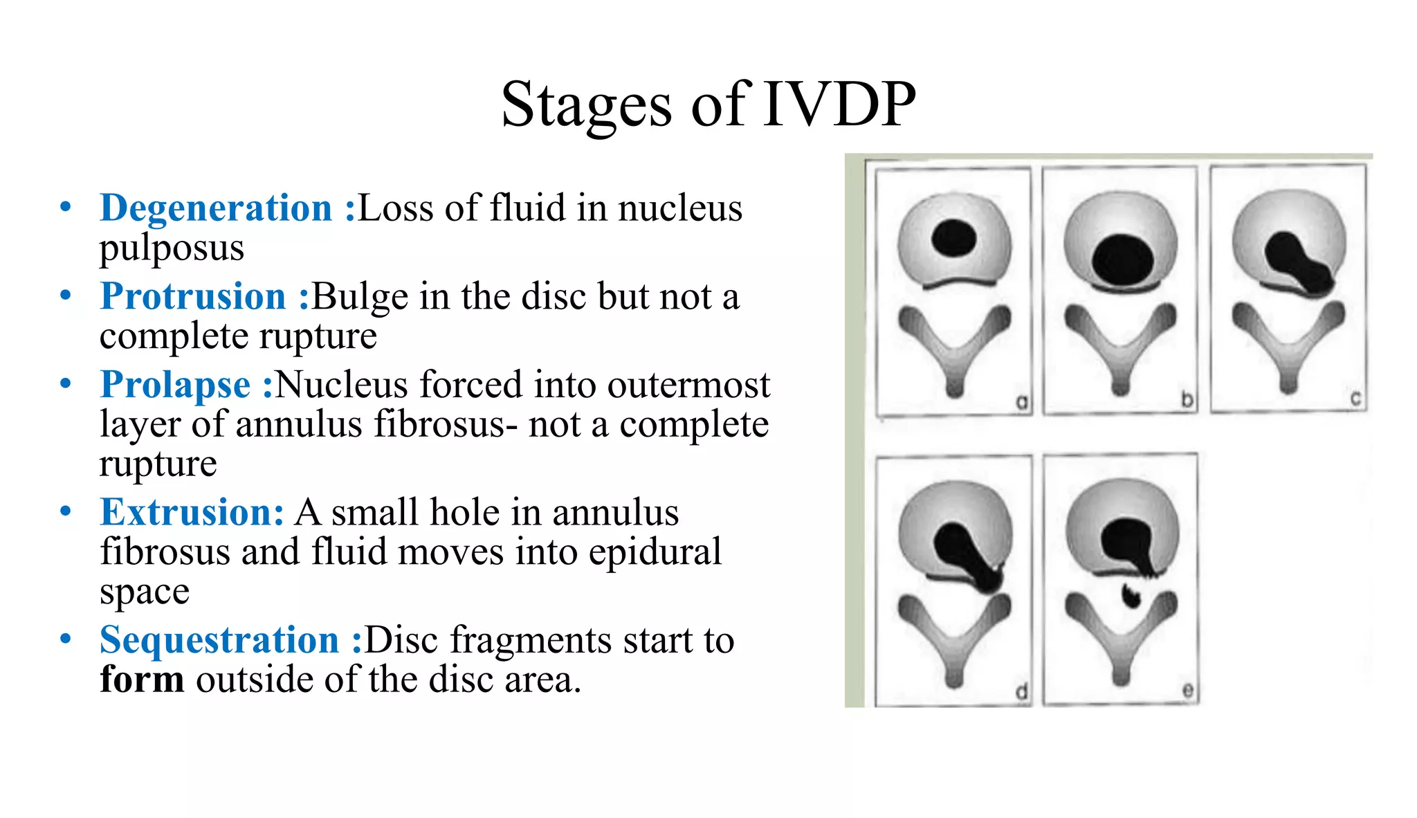 Inter vertebral disc prolapse | PPTX