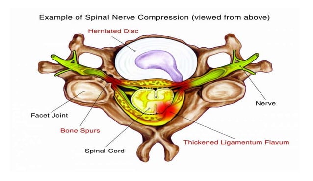 Inter vertebral disc prolapse | PPTX