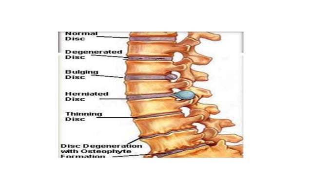Inter vertebral disc prolapse | PPTX