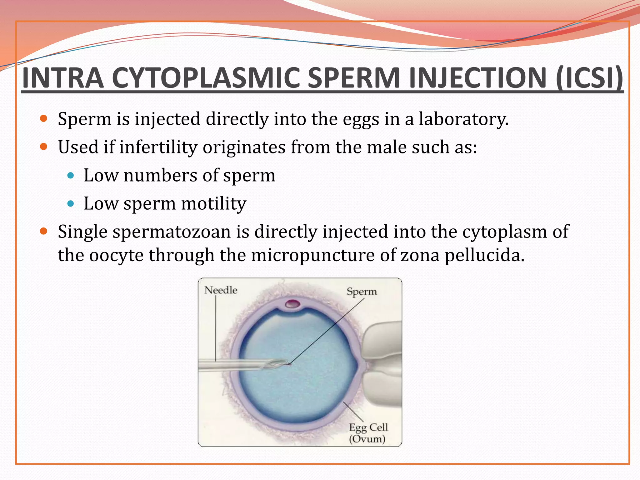 in vitro fertilization | PPTX