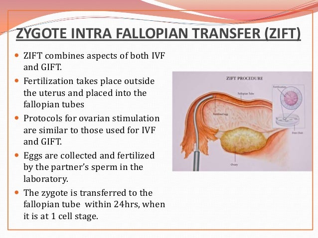 Zygote Intrafallopian Transfer Zygote Intrafallopian Transfer ...