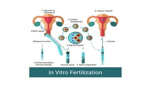 IN VITRO FERTILISATION IVF IVF.PDF INVITRO | PPT