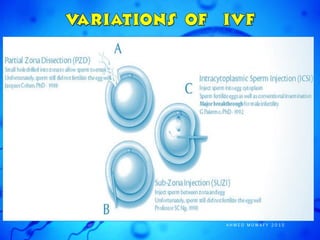 In vitro fertilization and embryo transfer "IVF"; Overview on the Story ...