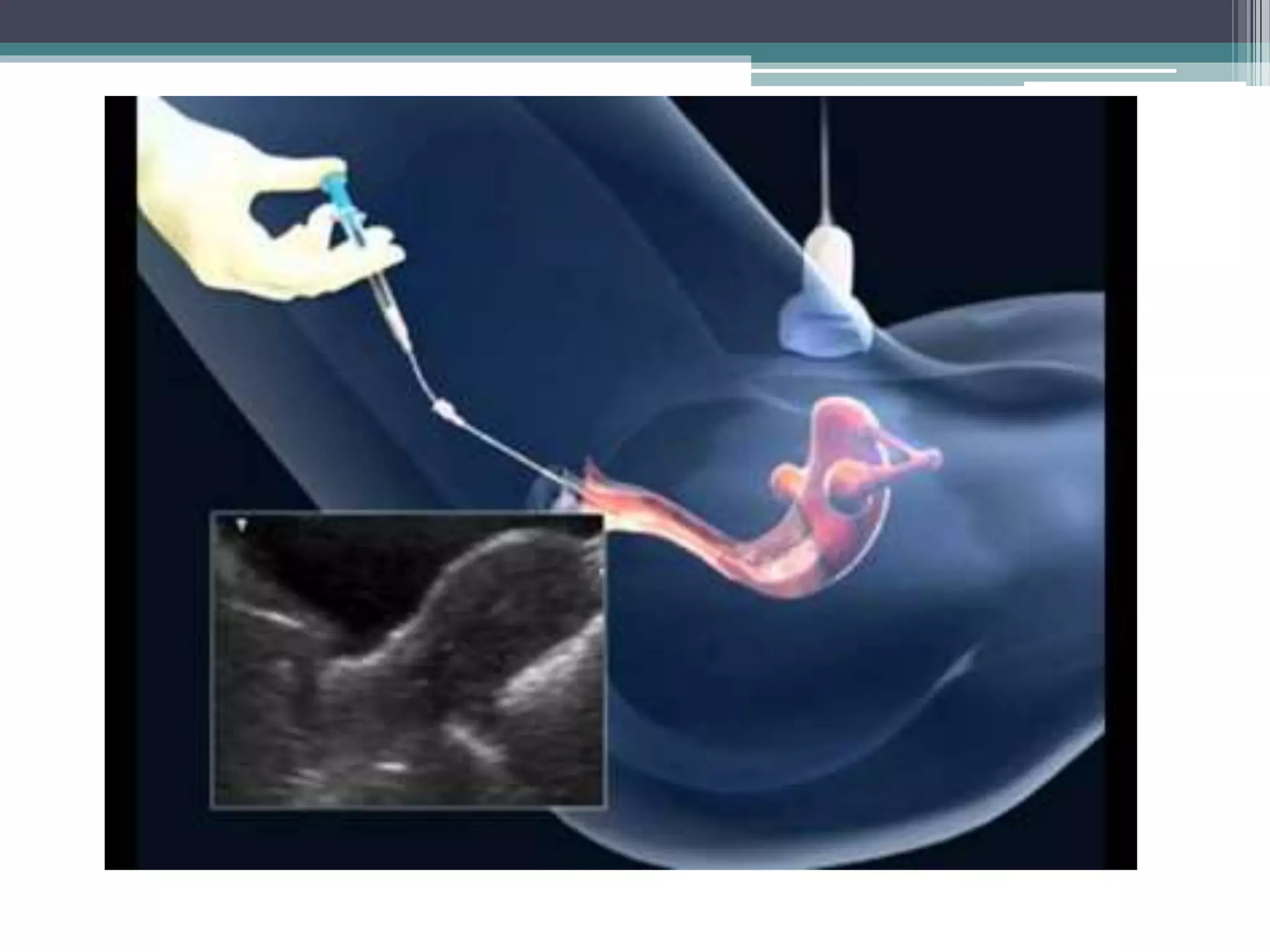 Invitro fertilization in humans(IVF) | PPTX