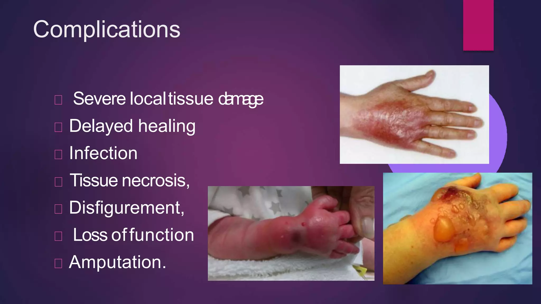 IV infiltration and Extravasation | PPTX