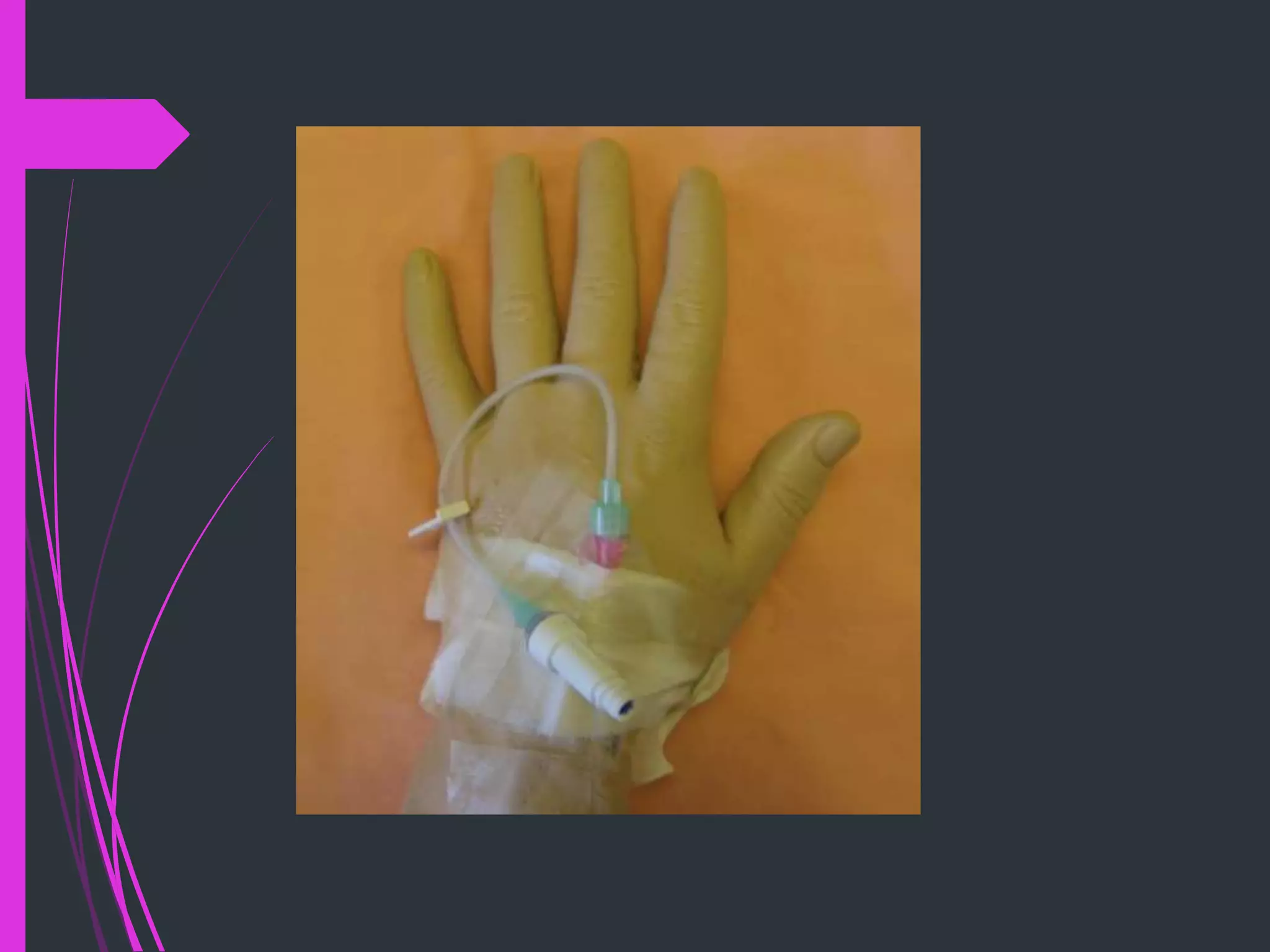 Iv infusion ppt | PPTX