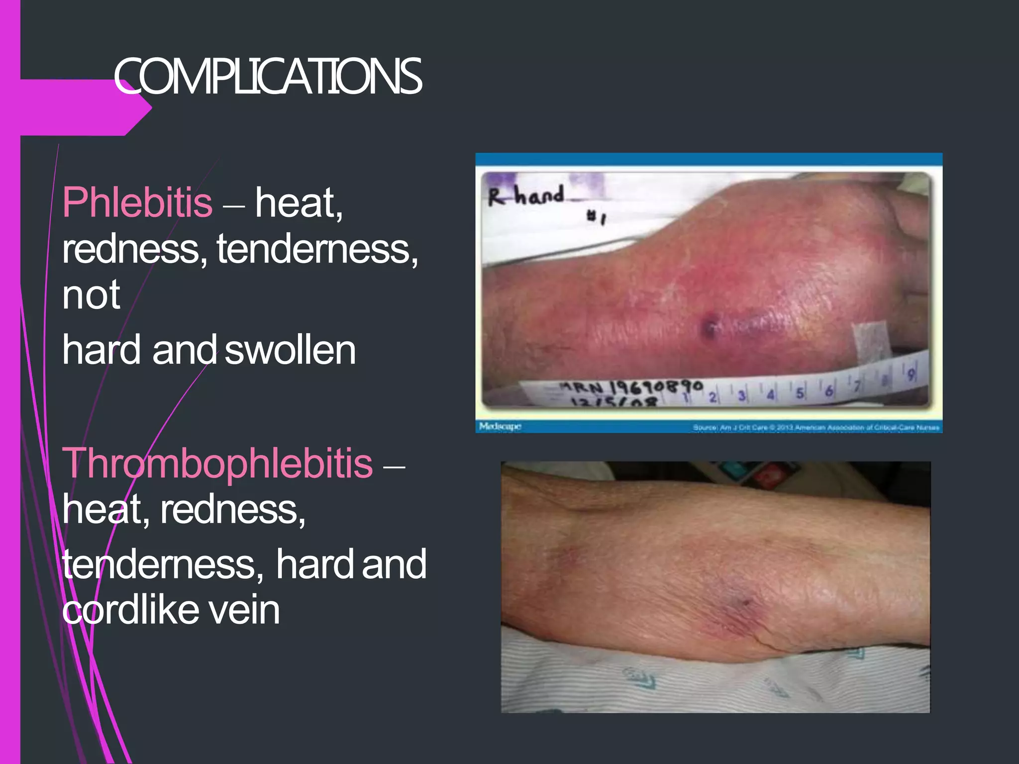 Iv infusion ppt | PPTX