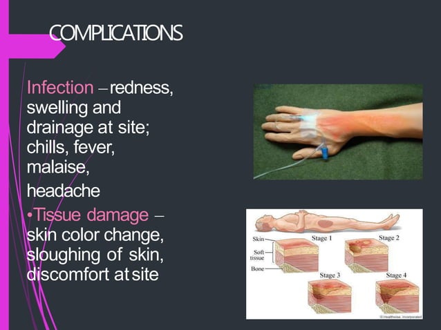 Iv infusion ppt | PPTX