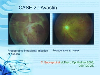 Avastin Injection