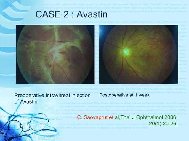 NW2007 Intravitreal Avastin Injection for Diabetic Retinopathy | PPT