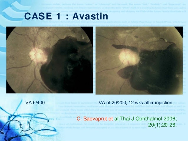 NW2007 Intravitreal Avastin Injection for Diabetic Retinopathy