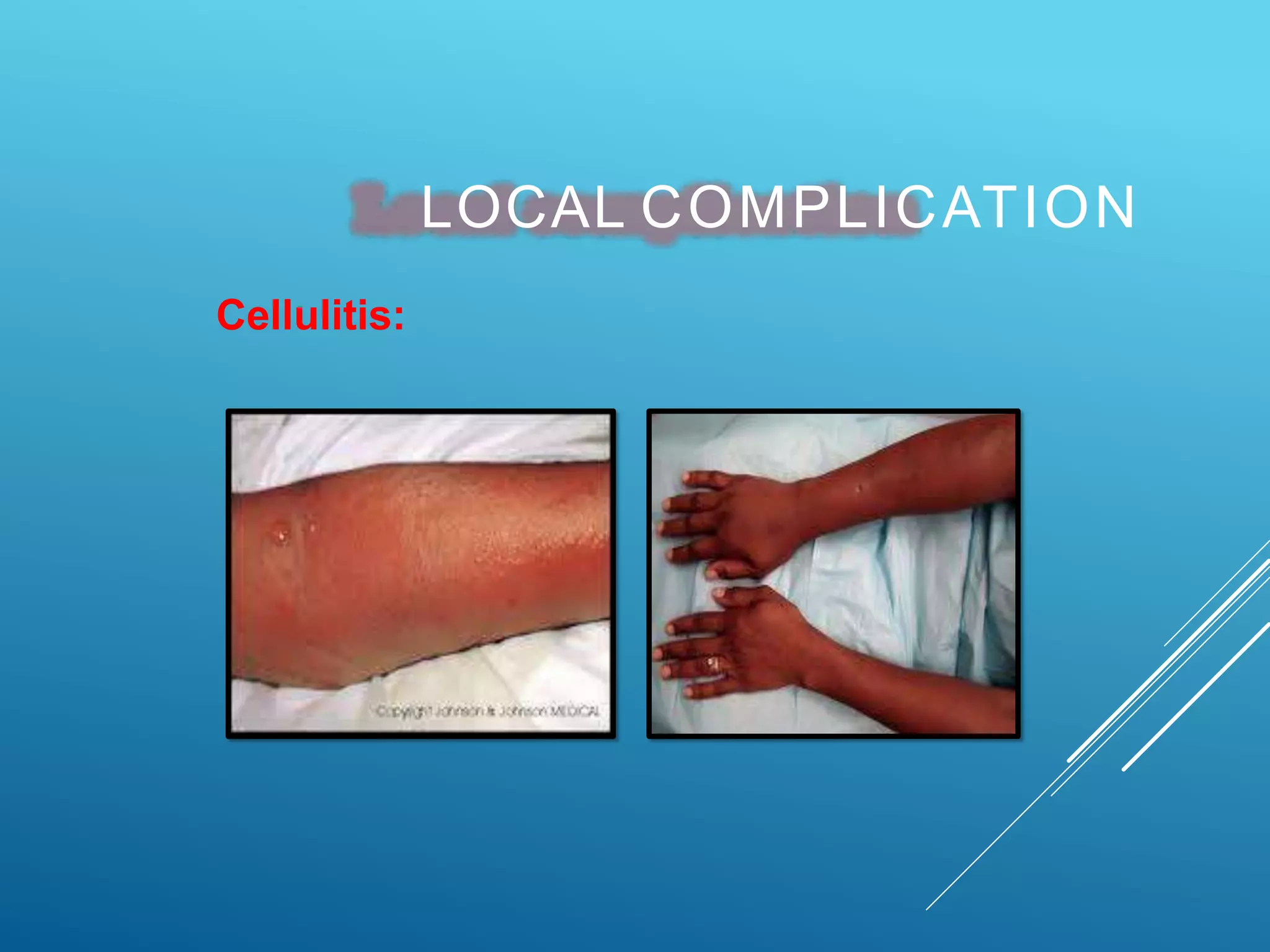 Intravenous Injection ppt | PPTX