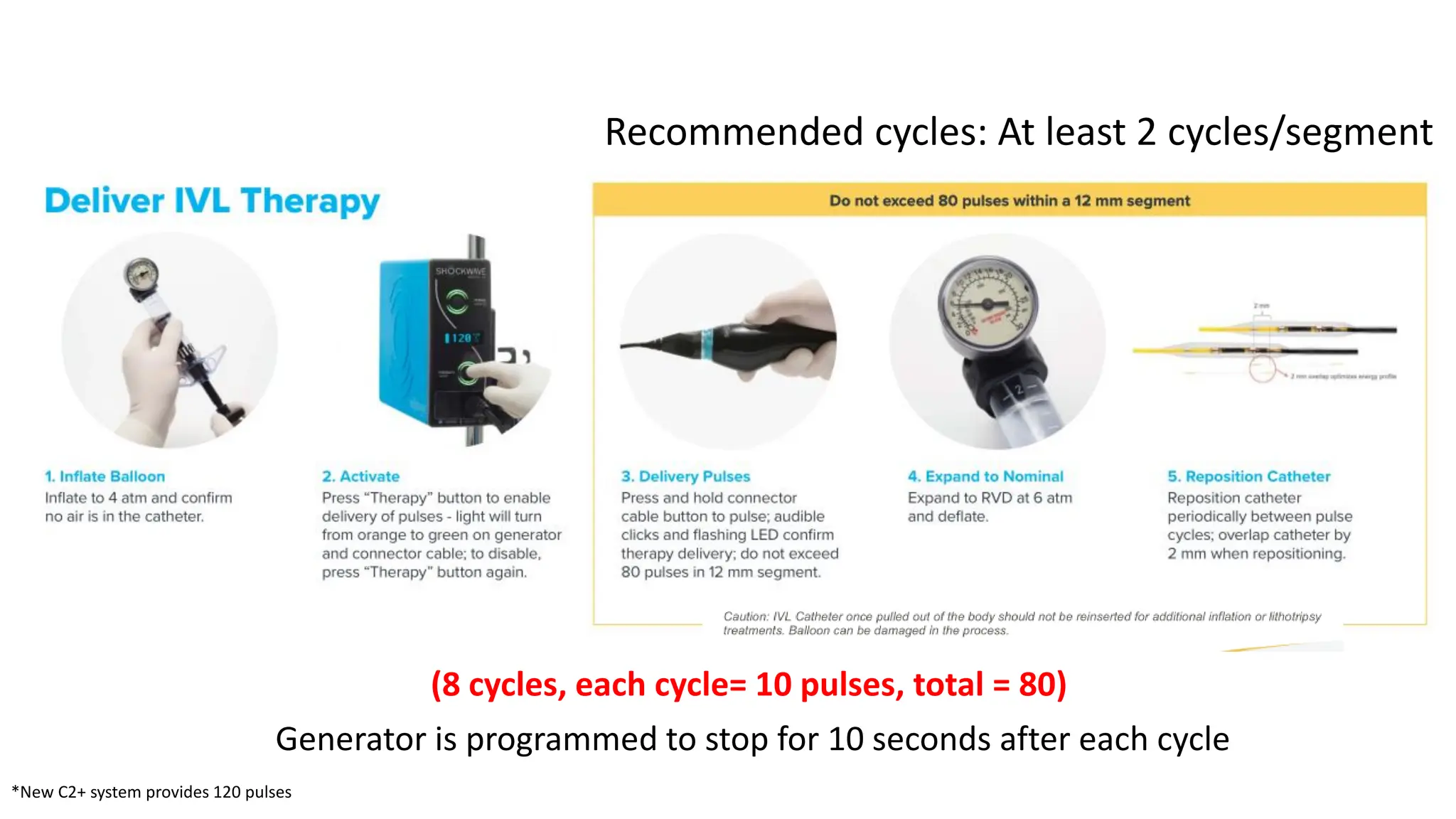 Coronary shock wave lithotripsy balloon (IVL) | PDF