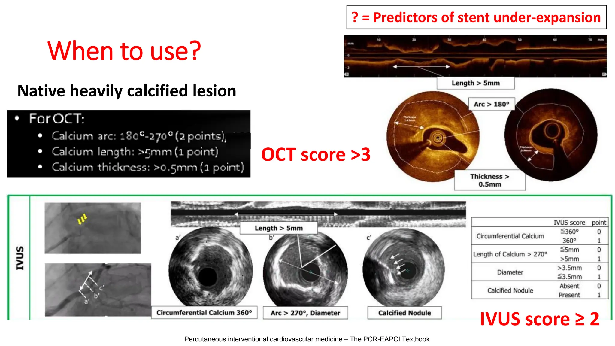 Coronary shock wave lithotripsy balloon (IVL) | PDF