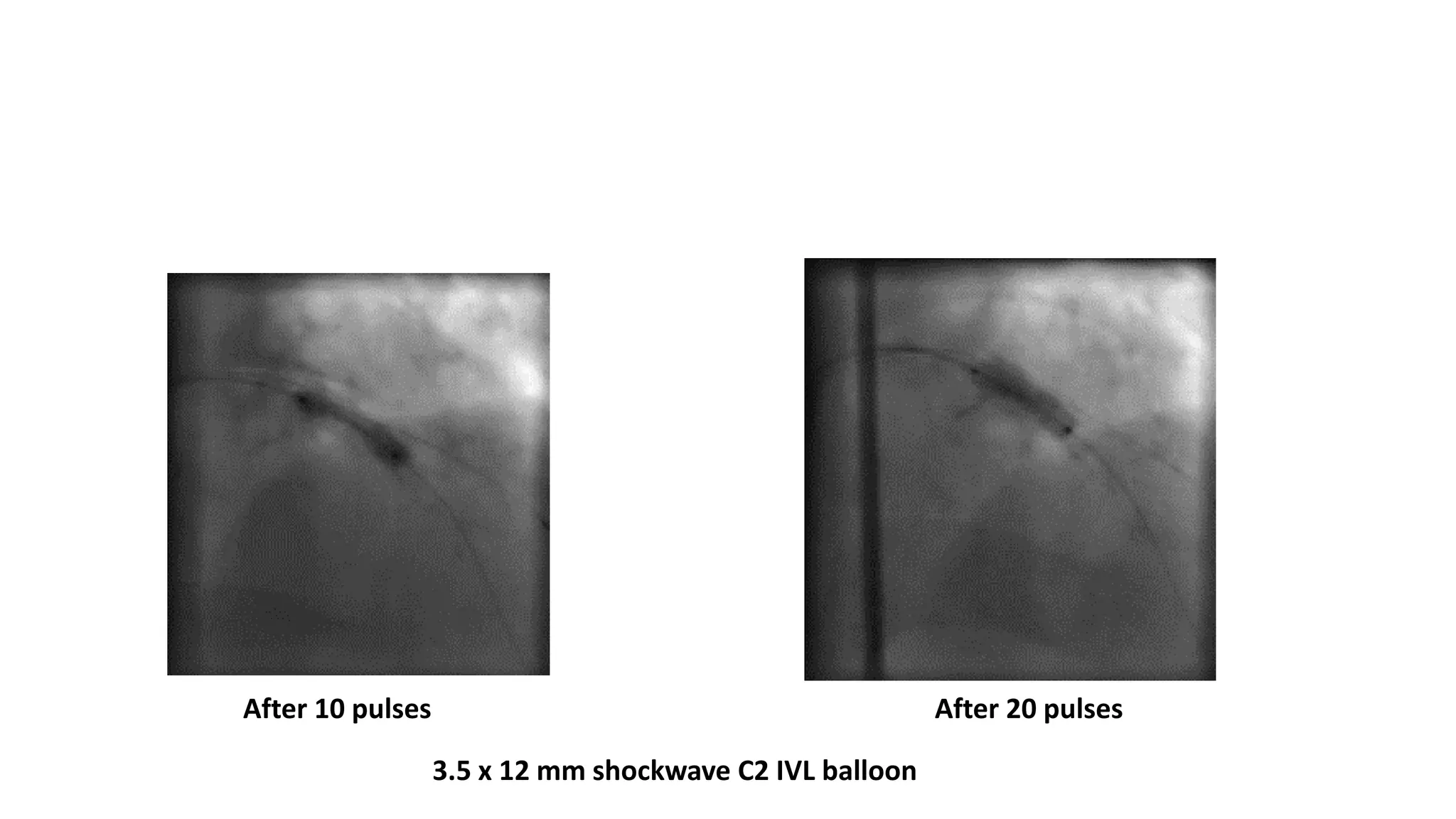 Coronary shock wave lithotripsy balloon (IVL) | PDF