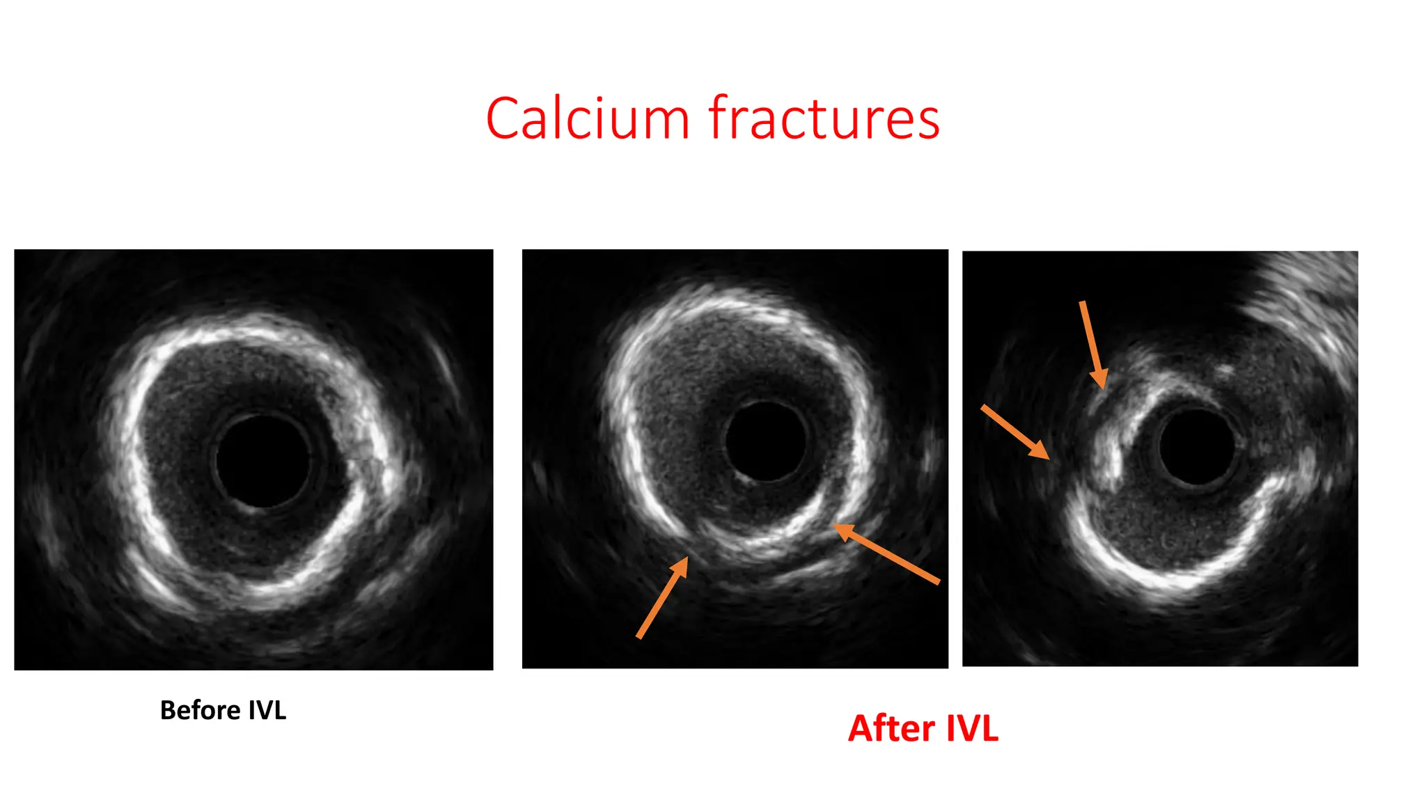 Coronary shock wave lithotripsy balloon (IVL) | PDF