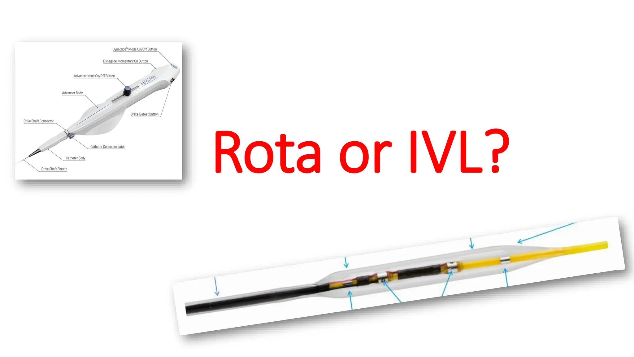 Coronary shock wave lithotripsy balloon (IVL) | PDF