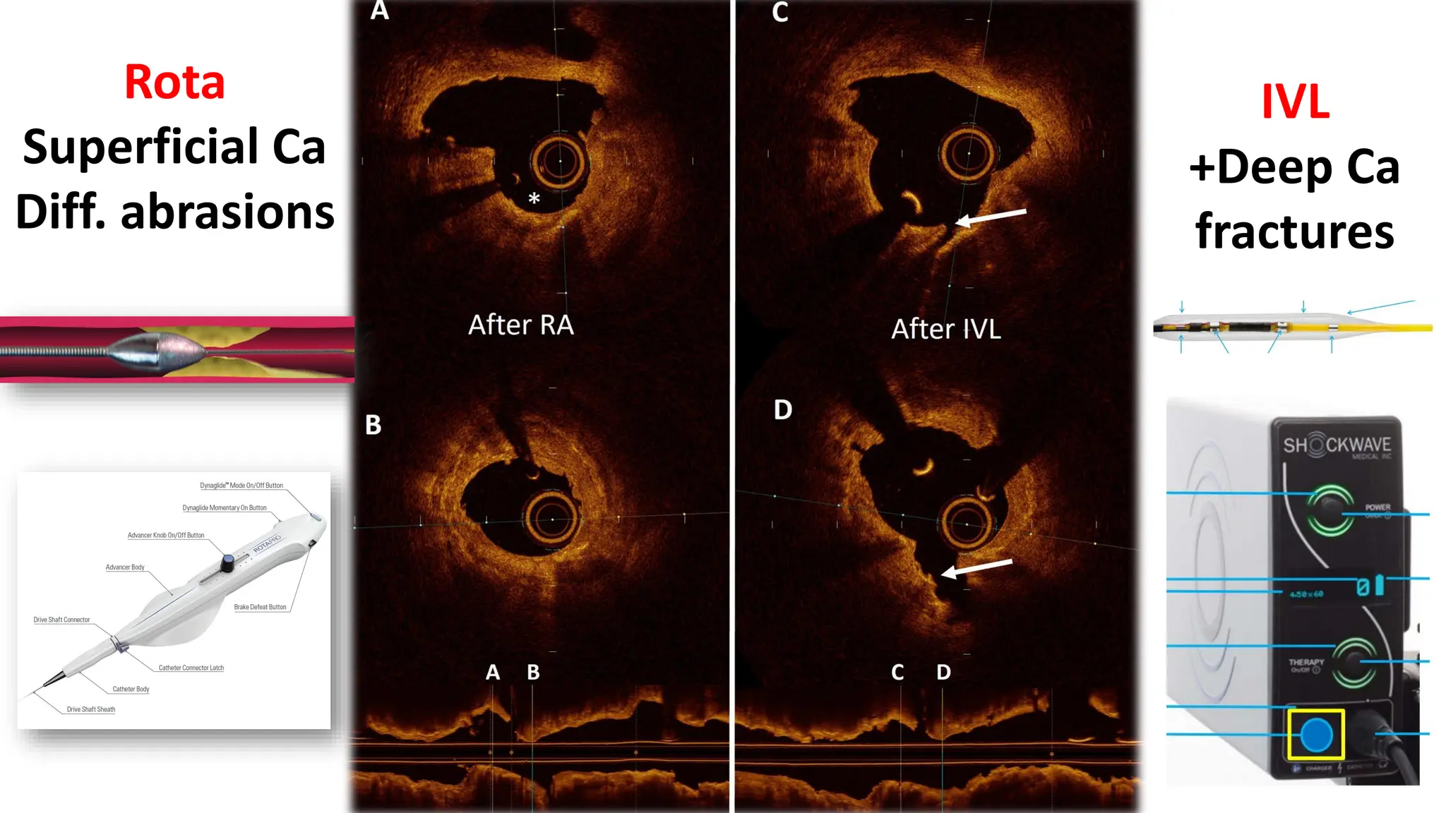 Coronary shock wave lithotripsy balloon (IVL) | PDF