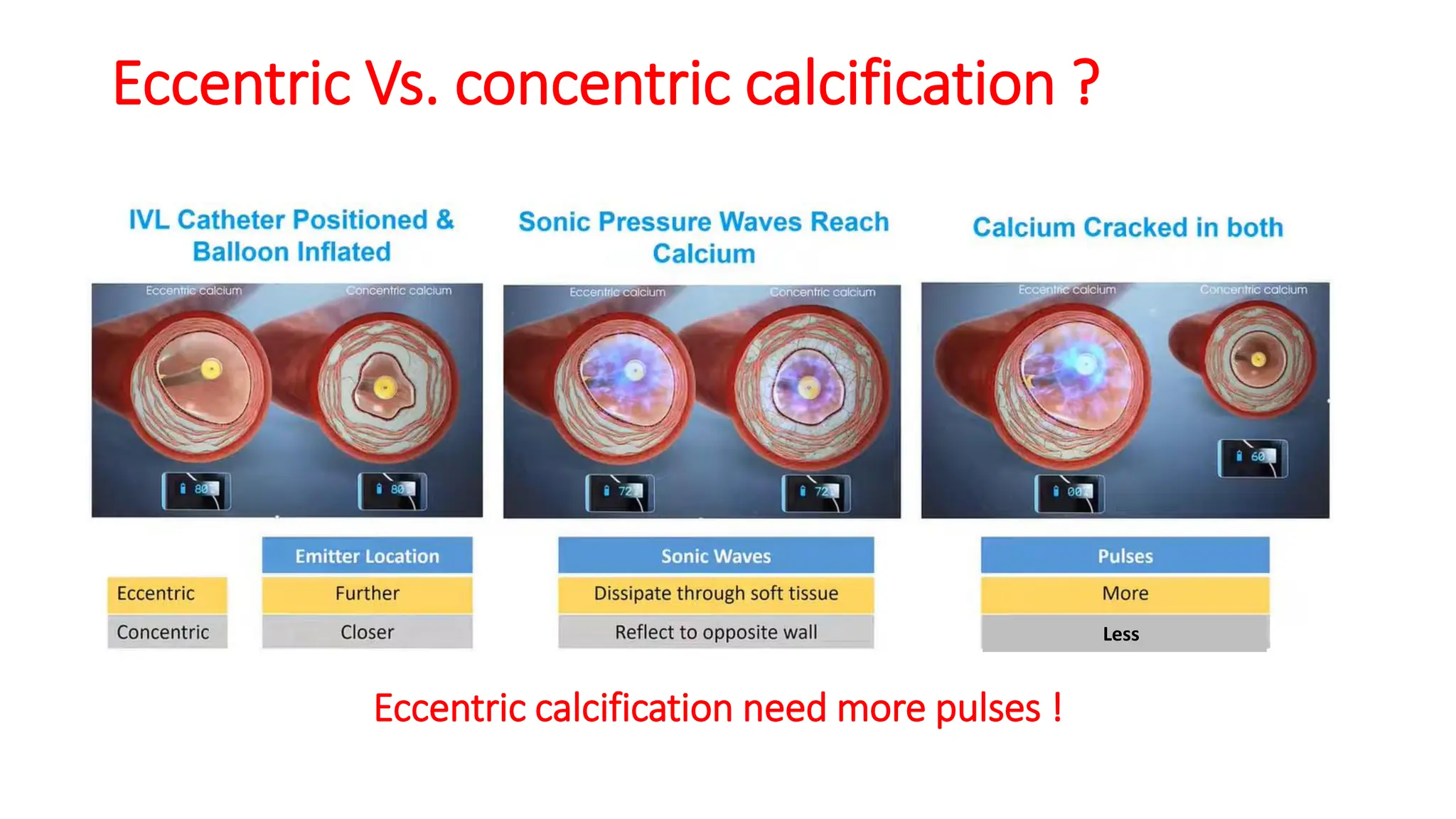 Coronary shock wave lithotripsy balloon (IVL) | PDF