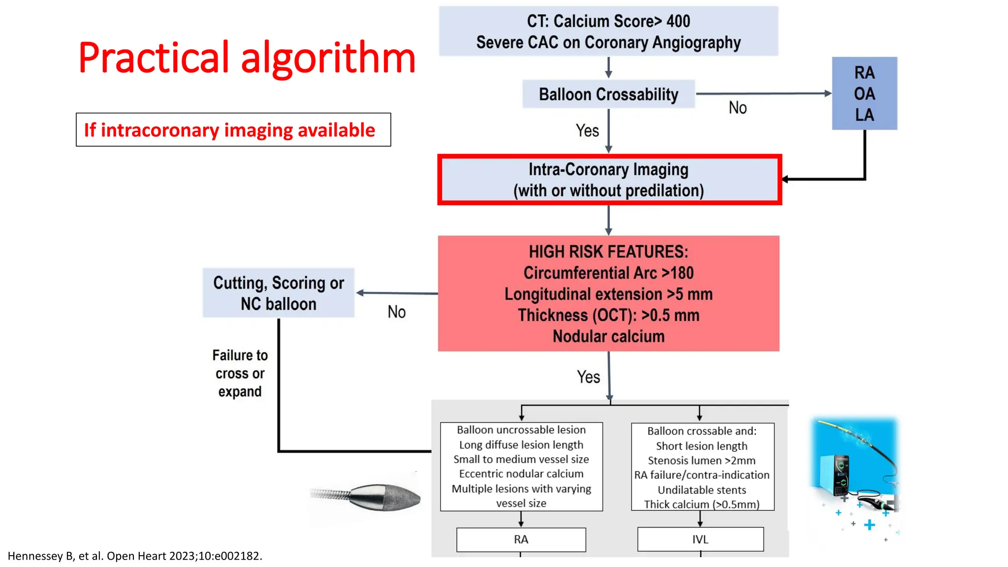 Coronary shock wave lithotripsy balloon (IVL) | PDF