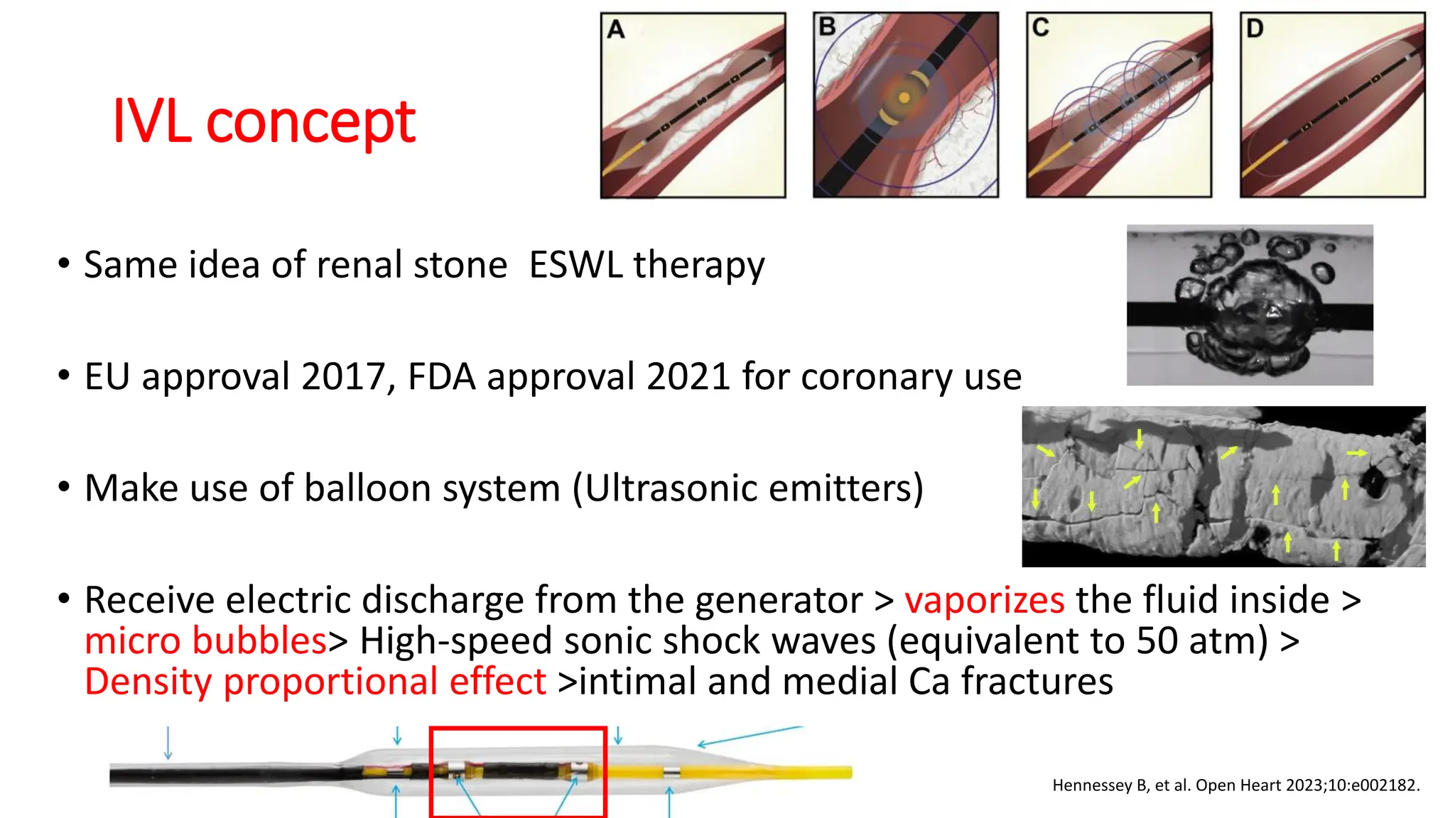 Coronary shock wave lithotripsy balloon (IVL) | PDF