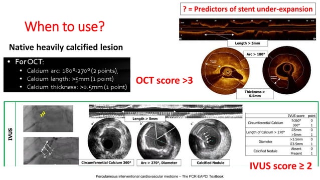 Coronary shock wave lithotripsy balloon (IVL) | PDF | Heart and ...