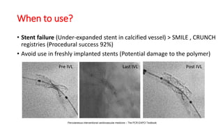 Coronary shock wave lithotripsy balloon (IVL) | PDF