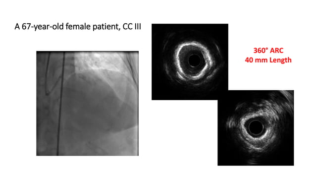 Coronary shock wave lithotripsy balloon (IVL) | PDF | Heart and ...