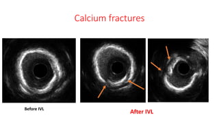 Coronary shock wave lithotripsy balloon (IVL) | PDF