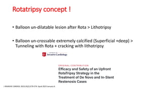 Coronary shock wave lithotripsy balloon (IVL) | PDF