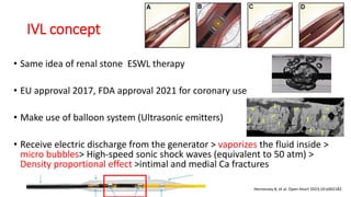 Coronary shock wave lithotripsy balloon (IVL) | PDF