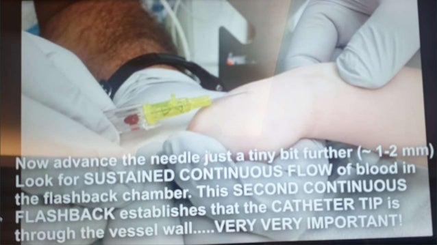 Iv line insertion in children | PPTX