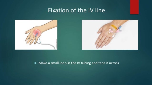 Iv line insertion in children | PPTX