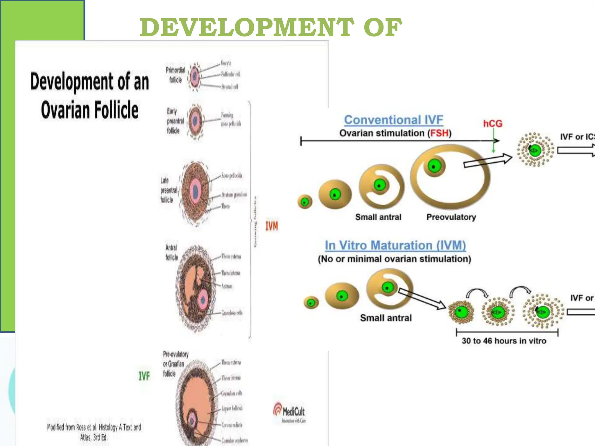 IVM (In vitro oocyte maturation).pptx