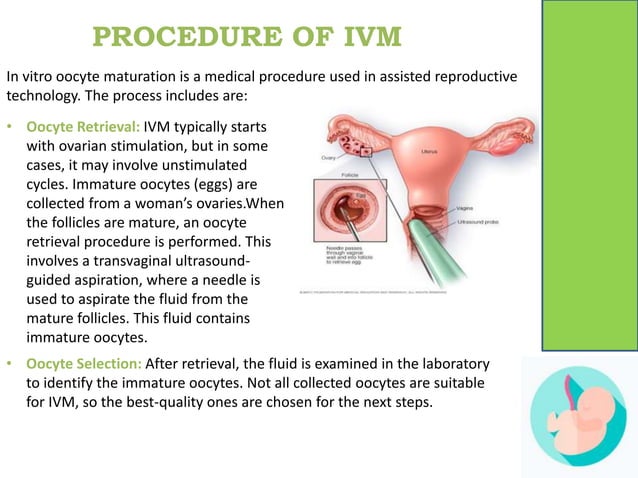 IVM (In vitro oocyte maturation).pptx | Infertility | Reproductive Health