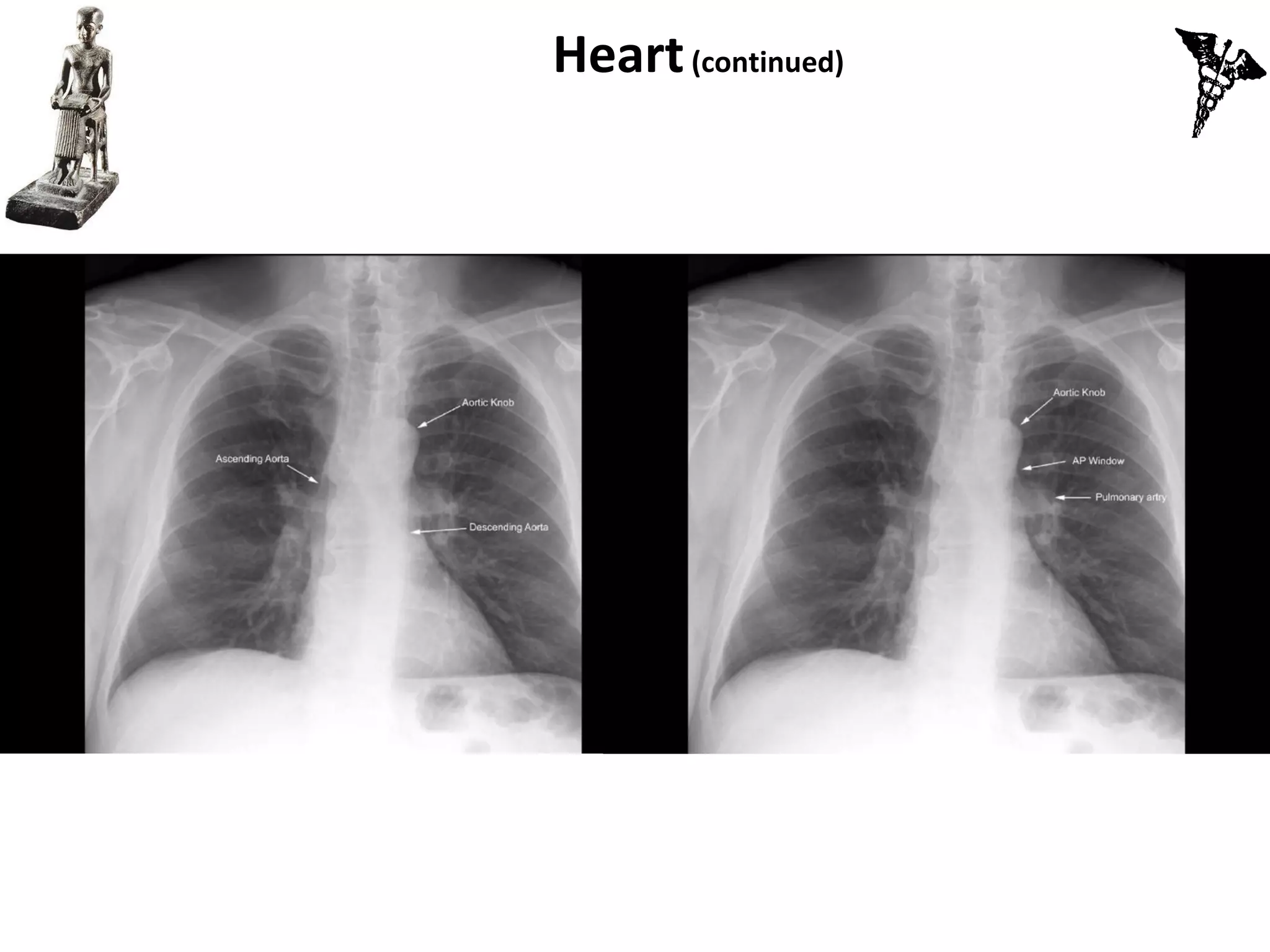 Basic CXR Interpretation_Diagnostic Radiography | PDF