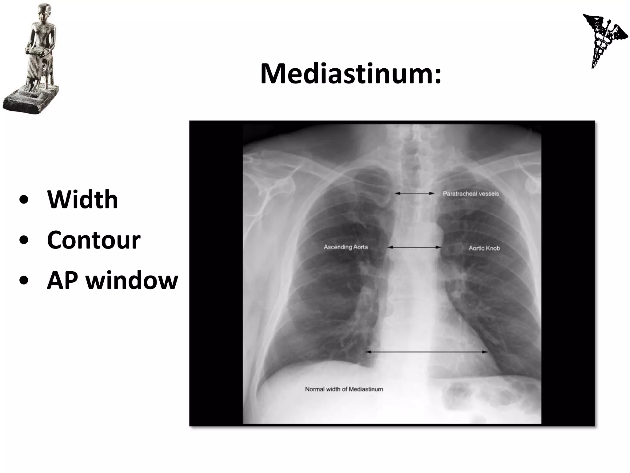 Basic CXR Interpretation_Diagnostic Radiography | PDF