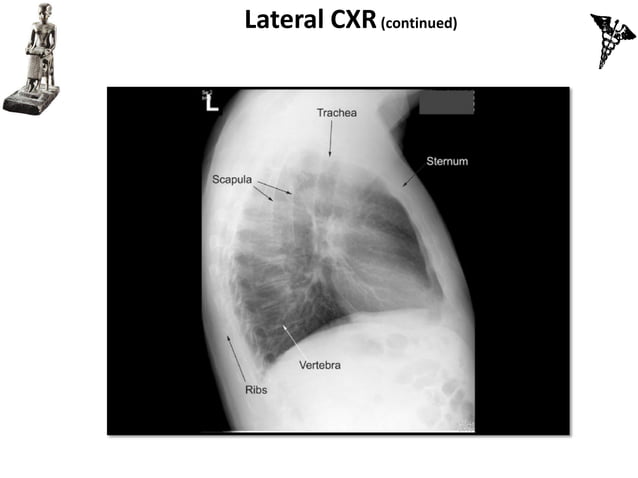 Basic CXR Interpretation_Diagnostic Radiography | PDF