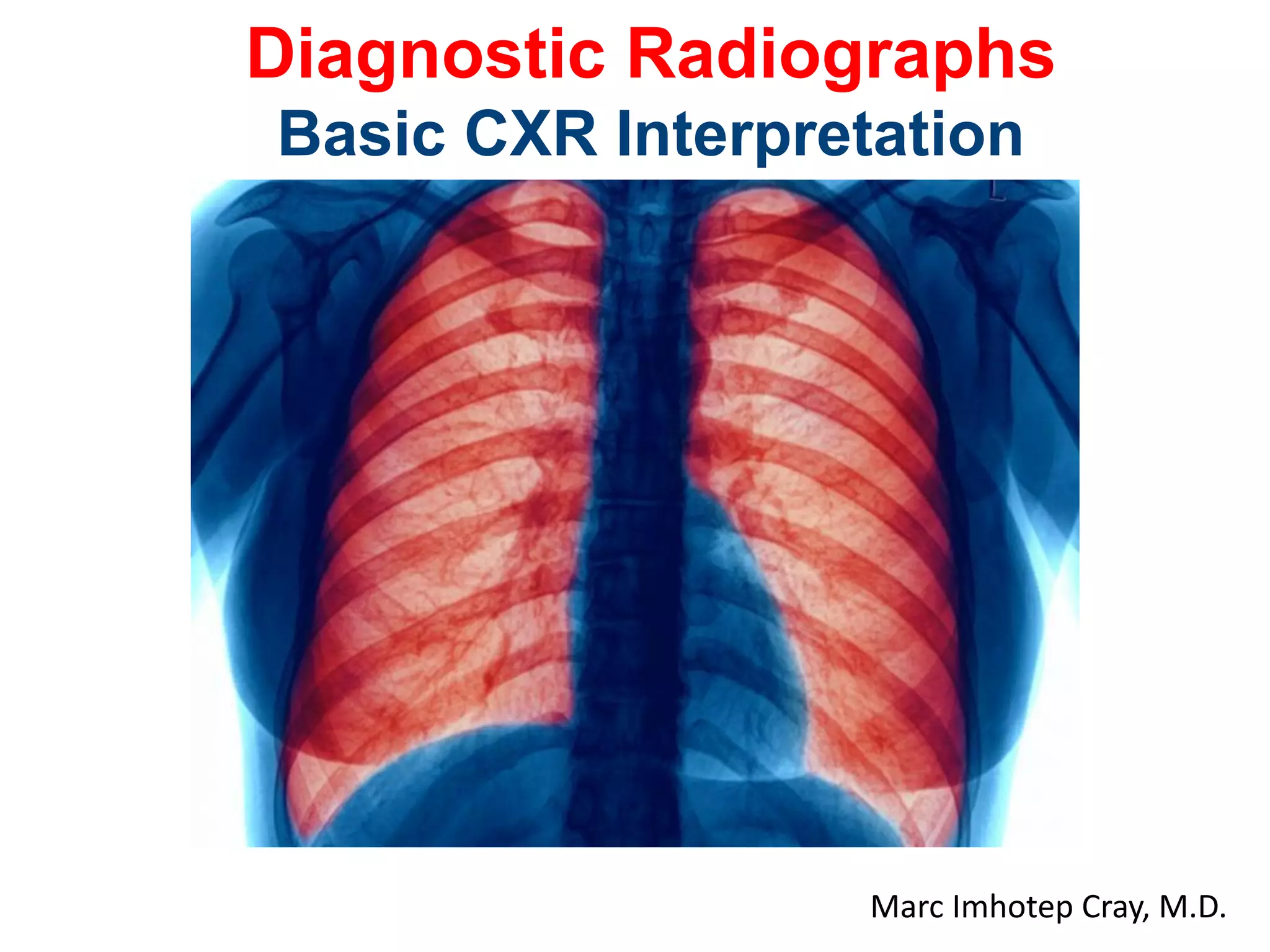 Basic CXR Interpretation_Diagnostic Radiographs | PDF