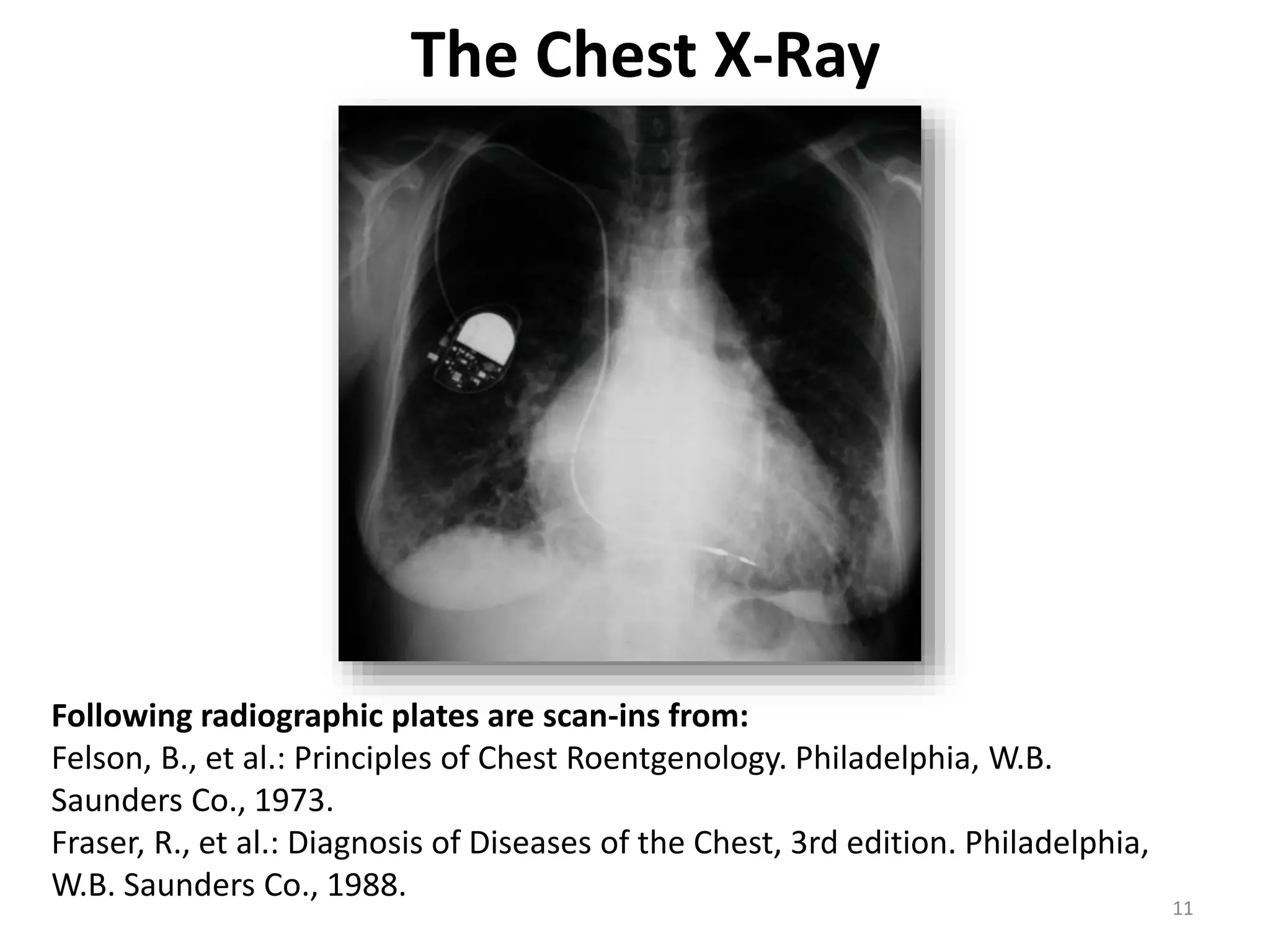 Basic CXR Interpretation_Diagnostic Radiographs | PDF