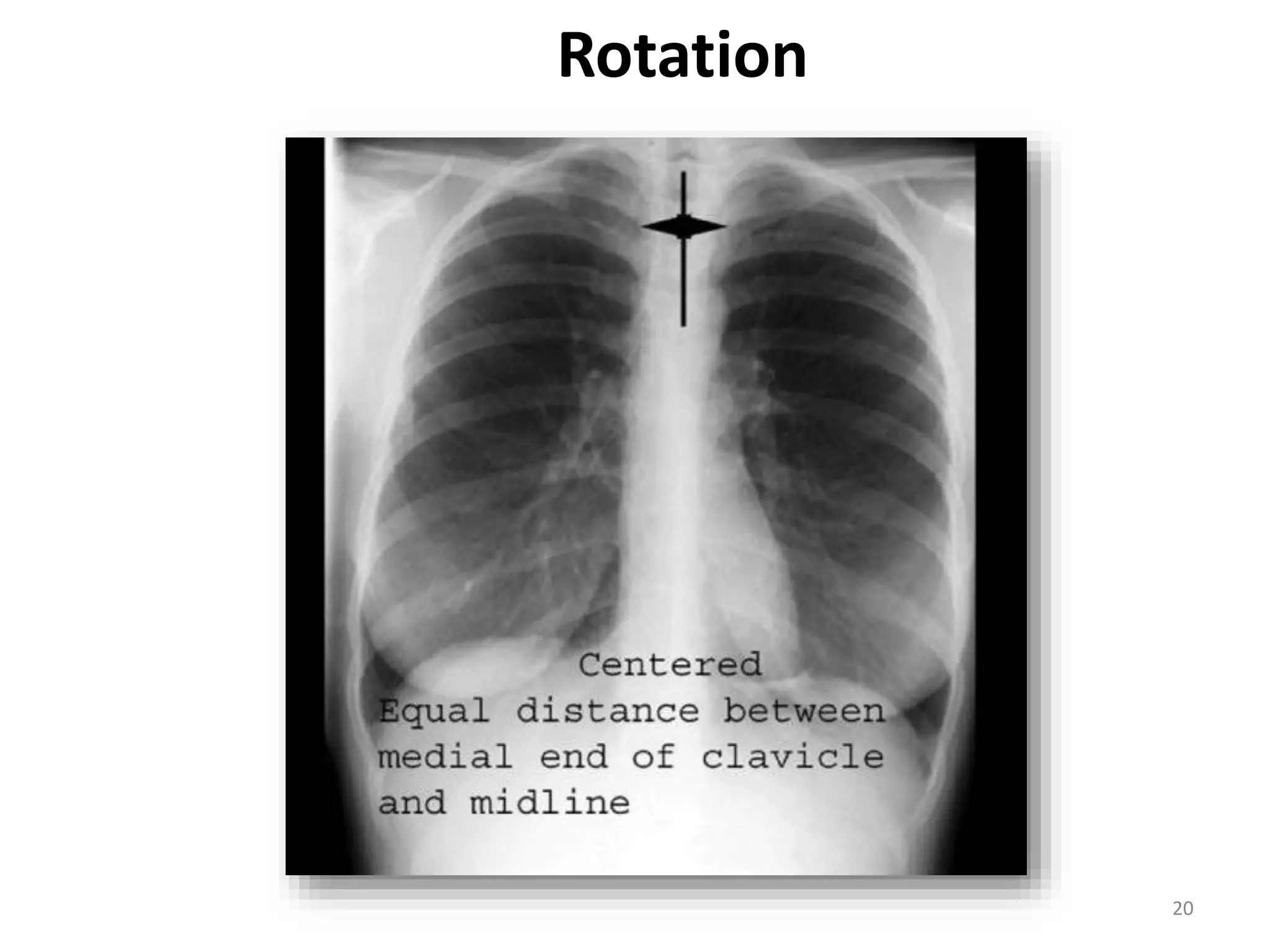Basic CXR Interpretation_Diagnostic Radiographs | PDF