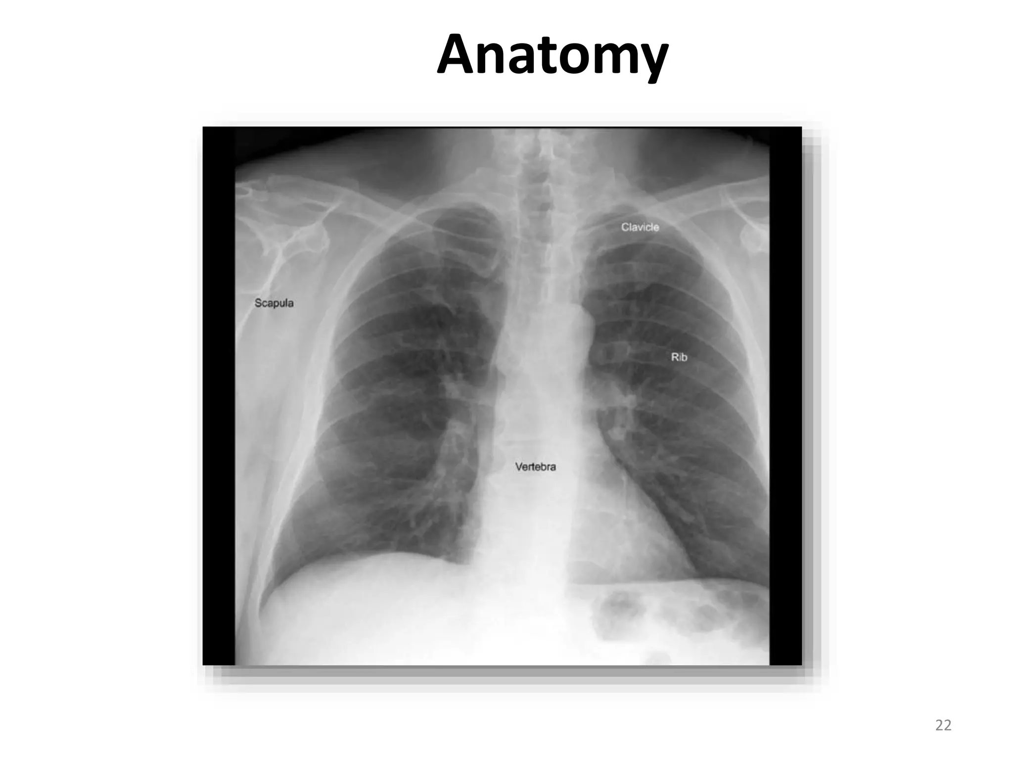 Basic CXR Interpretation_Diagnostic Radiographs | PDF