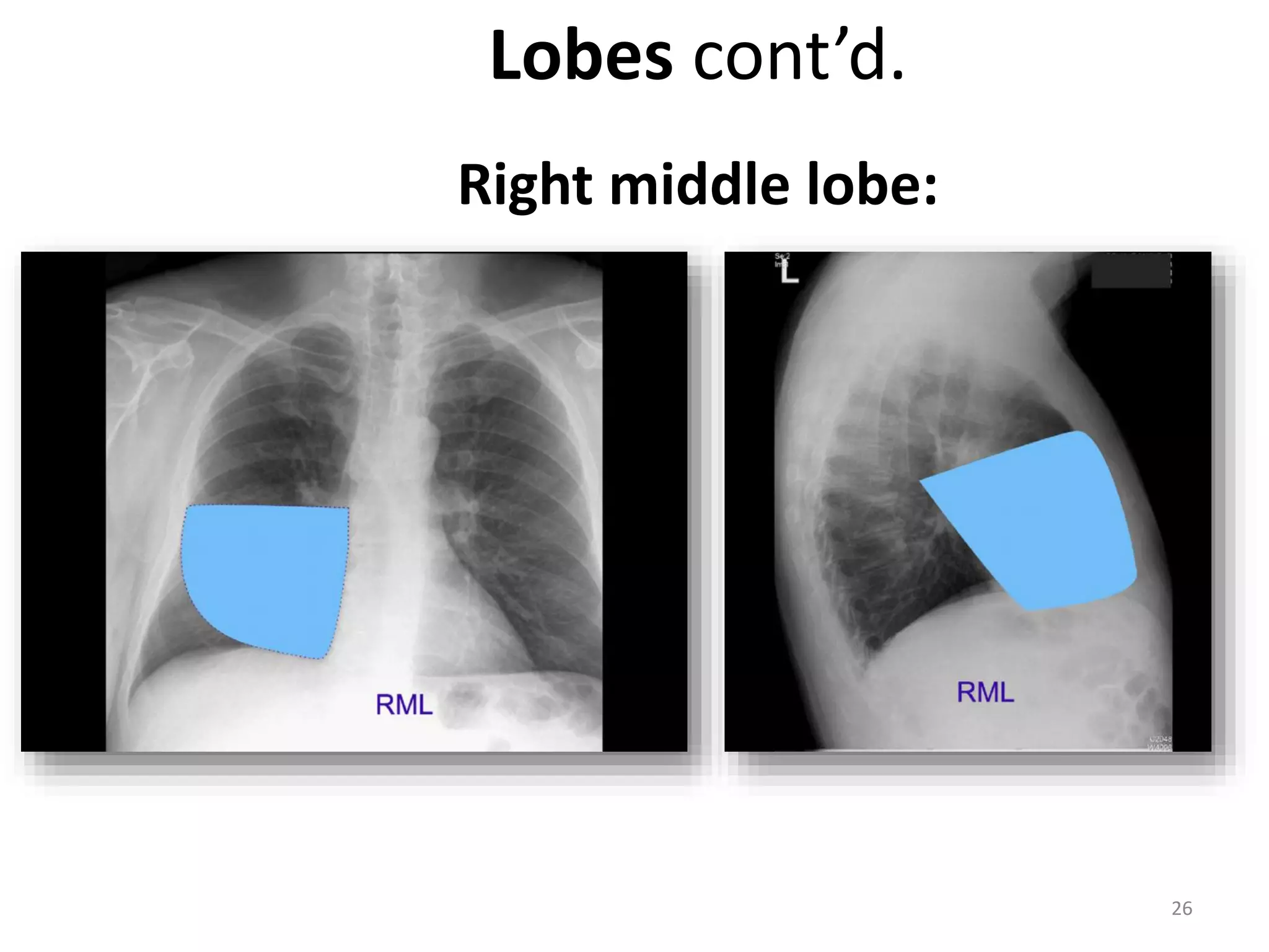 Basic CXR Interpretation_Diagnostic Radiographs | PDF
