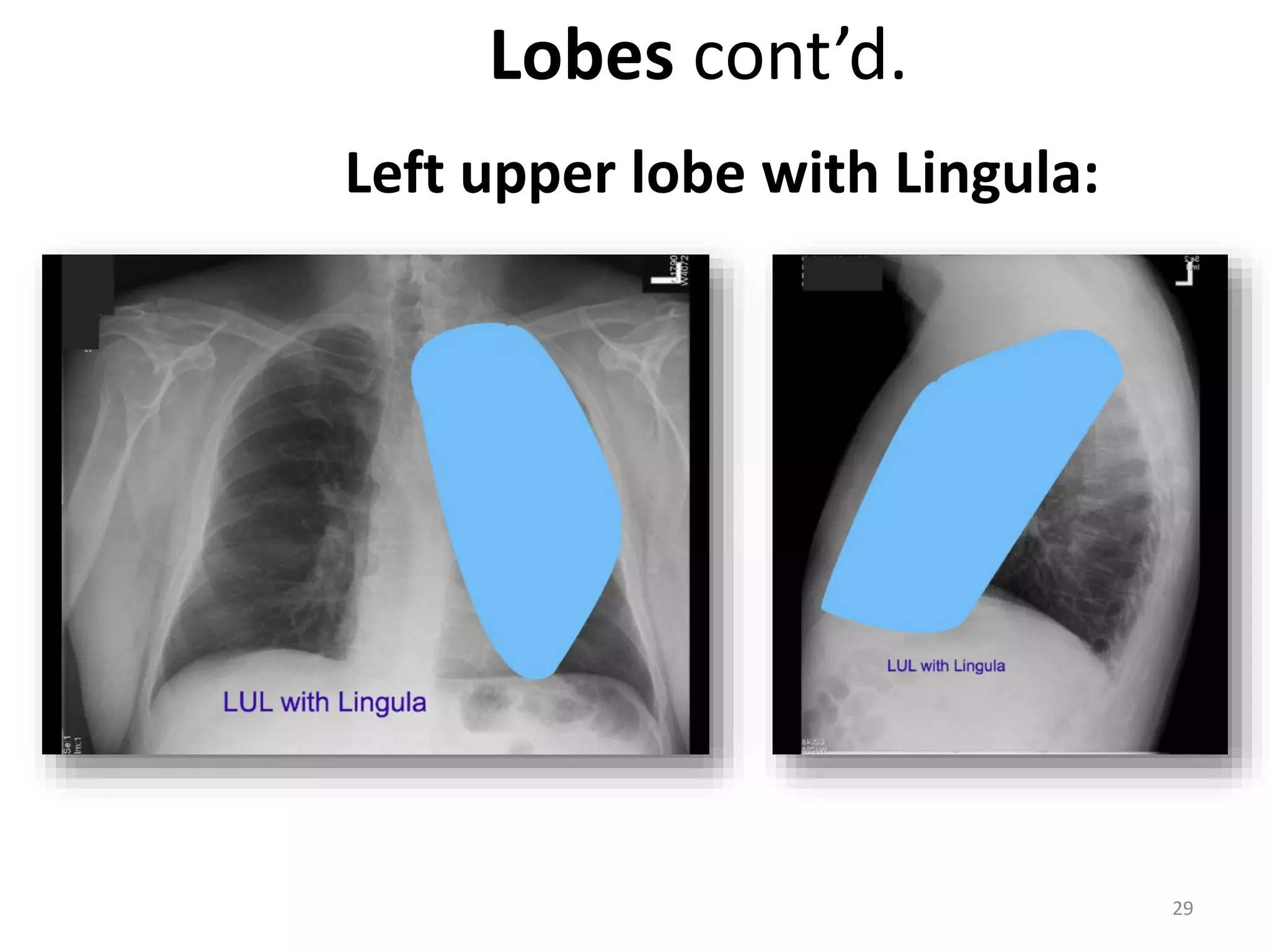 Basic CXR Interpretation_Diagnostic Radiographs | PDF