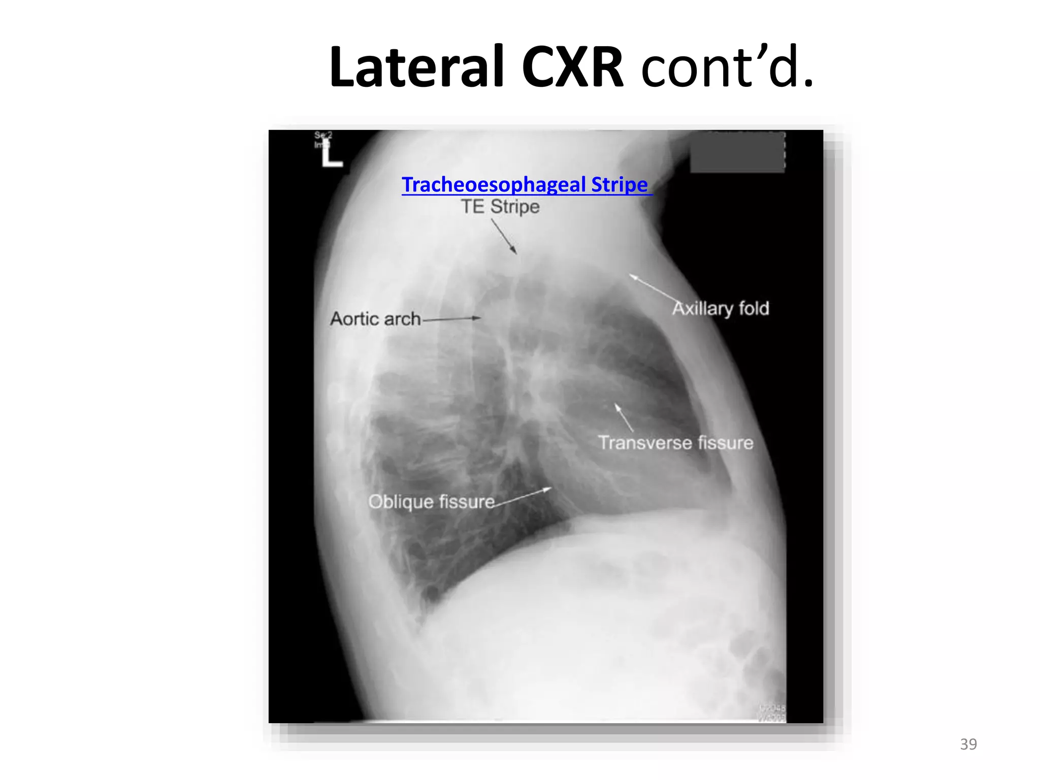 Basic CXR Interpretation_Diagnostic Radiographs | PDF